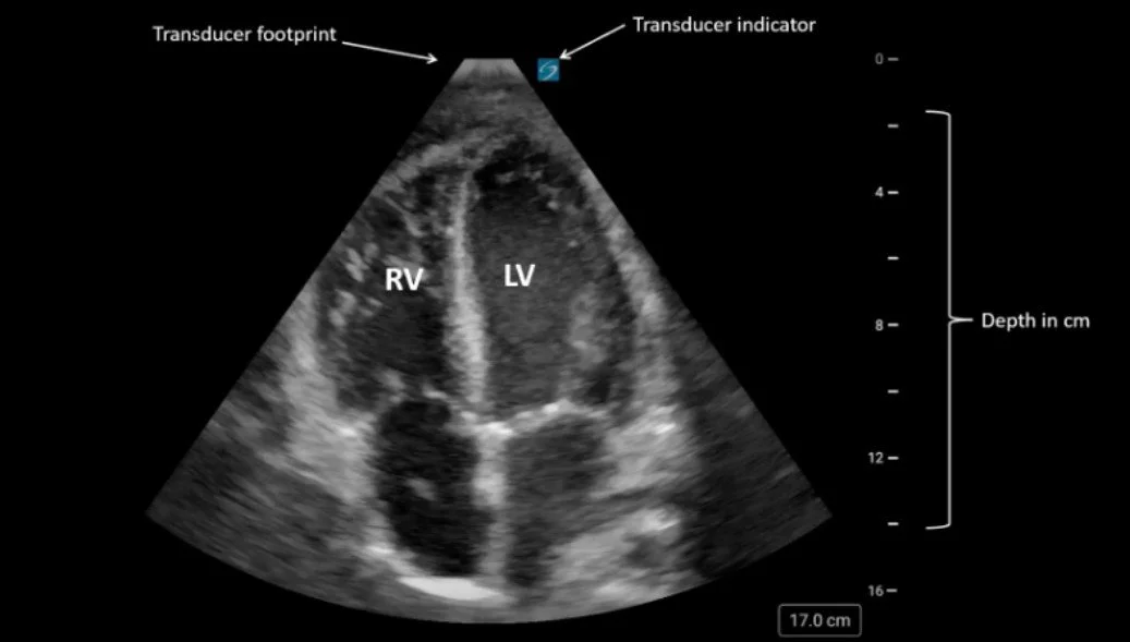 Transducer Types — Pulmonary POCUS