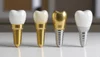 Can I Get a Gold Tooth Implant? Exploring Options and Benefits — Total ...