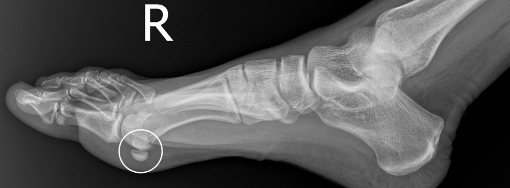 Pain under the big toe joint? It might be your Sesamoids. — Foot & Ankle
