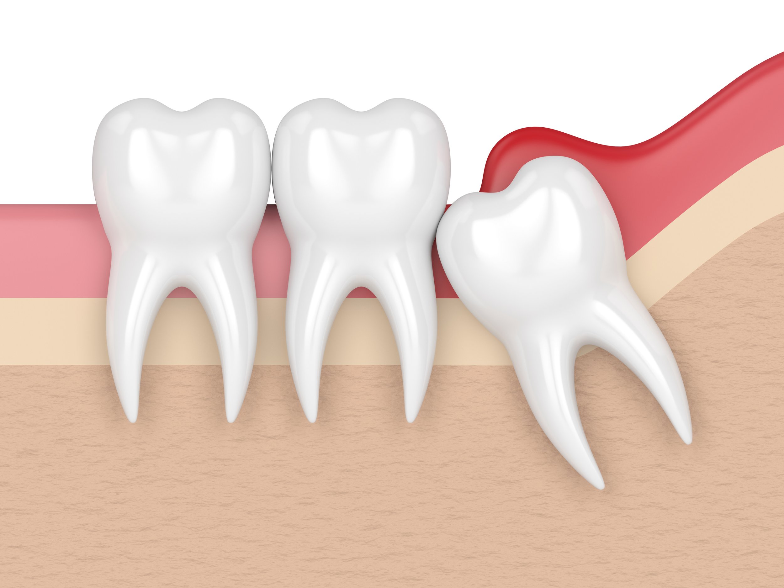Wisdom Tooth Surgery — Align Dental Surgery