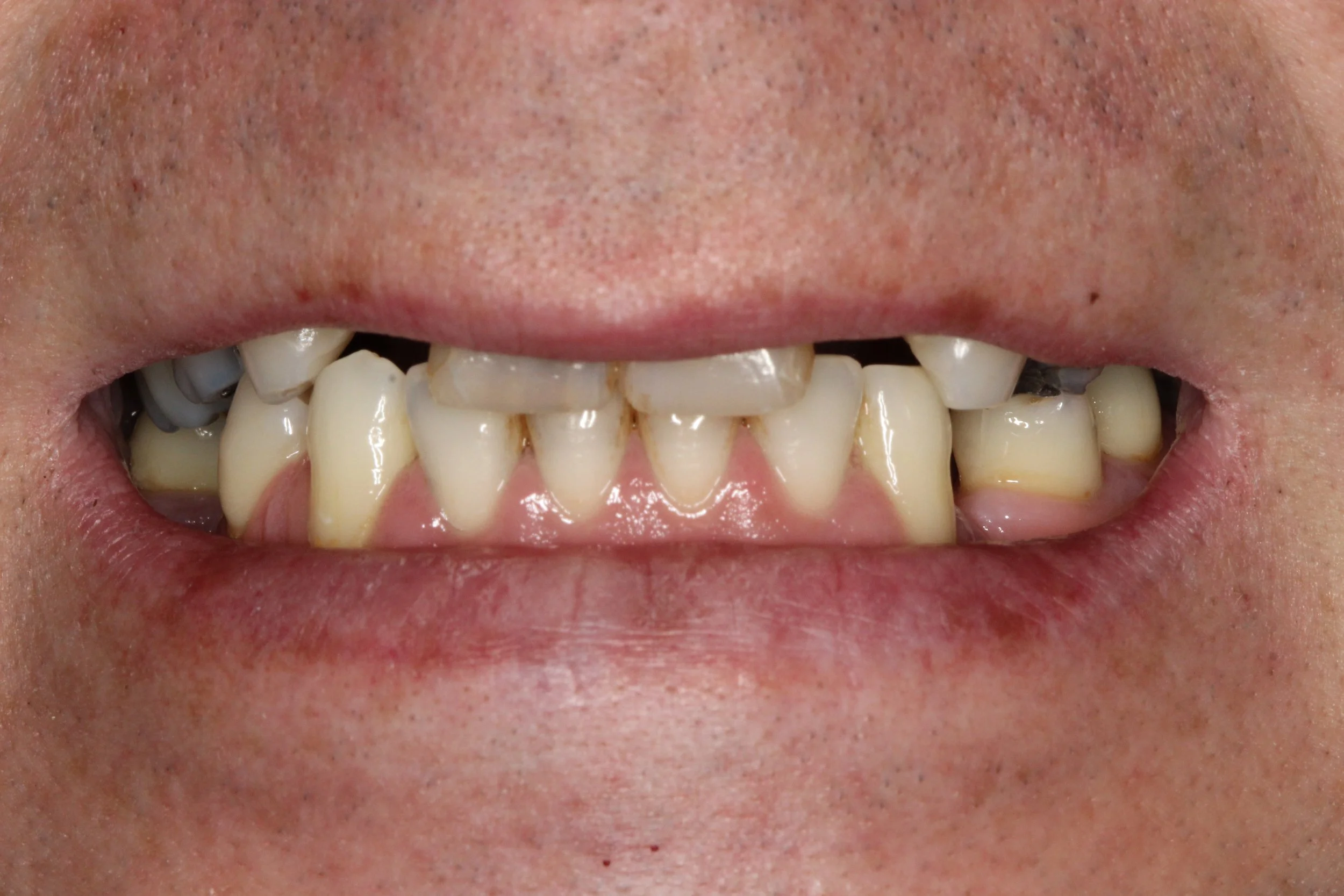 Loose Dentures? — Vanguard Dental