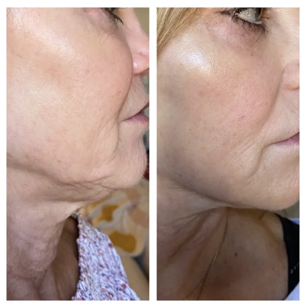 Jet Plasma Skin Tightening Gallery — At Ease Aesthetics
