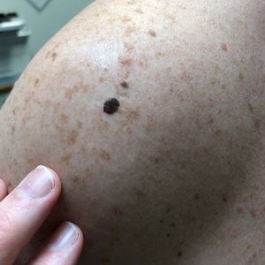 Types of Skin Cancer — The Skin Cancer Centre Coogee