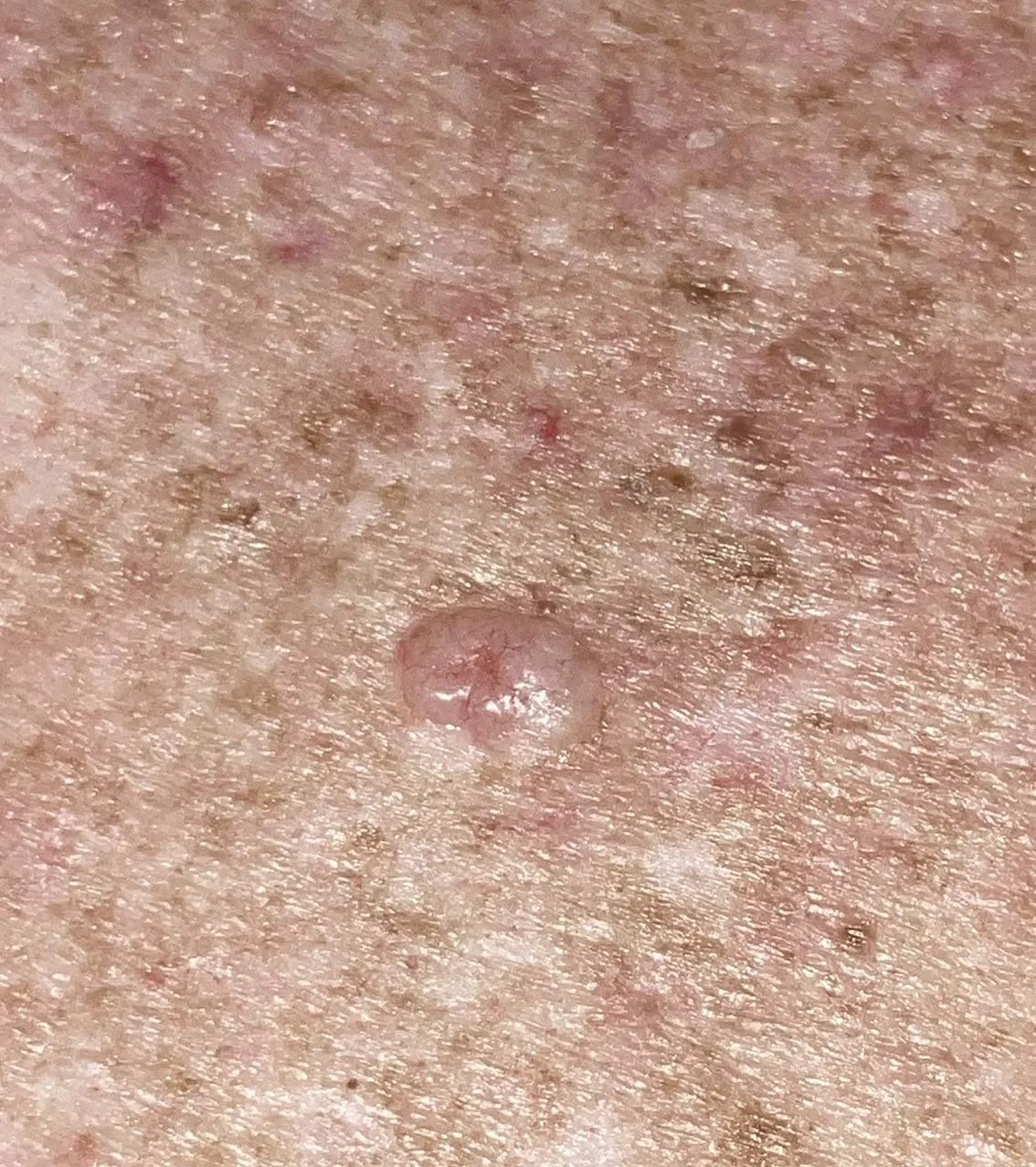 Types of Skin Cancer — The Skin Cancer Centre Coogee