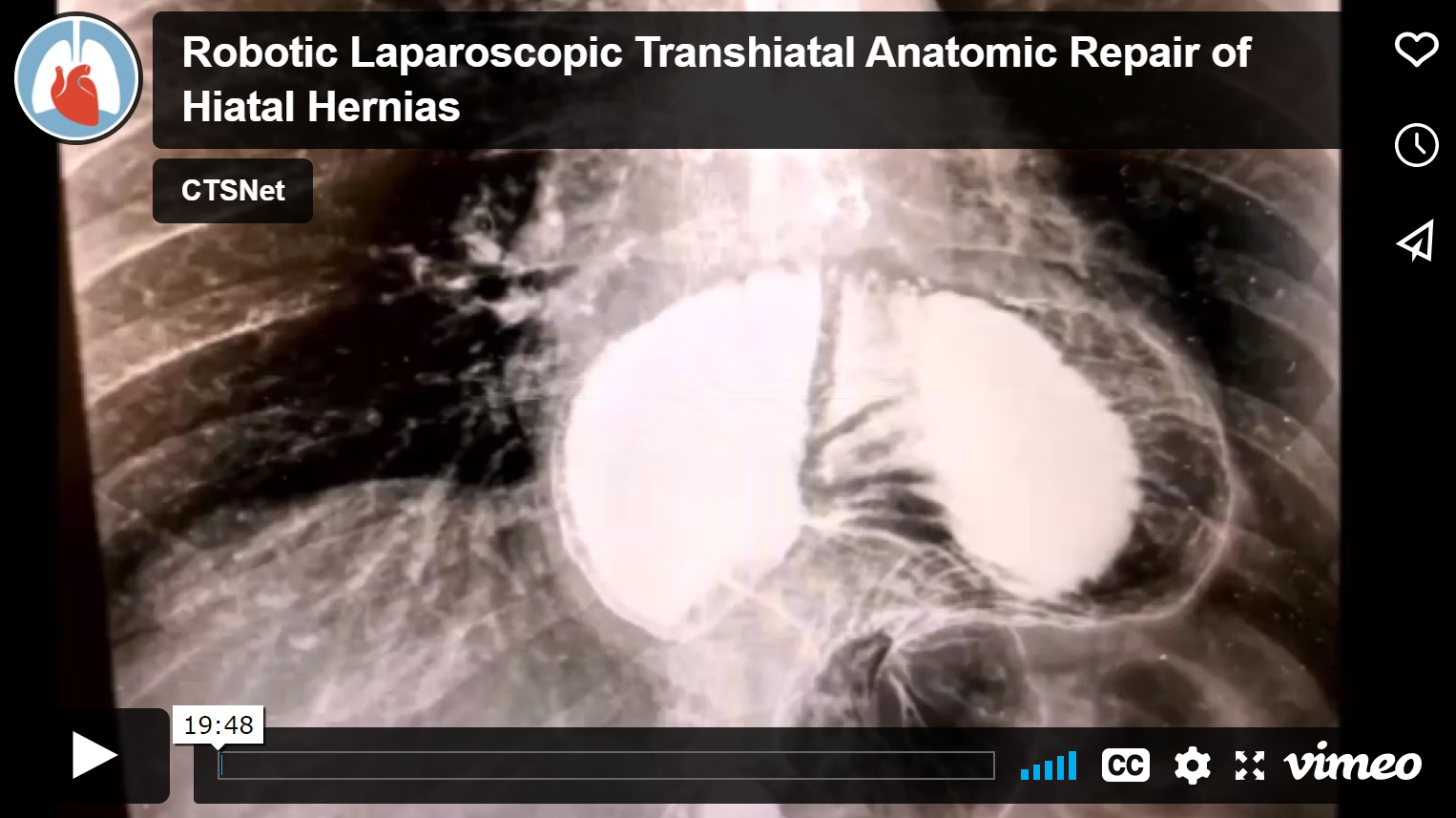 Robotic Anatomic and Physiologic Repair of Hiatal Hernias — Institute ...