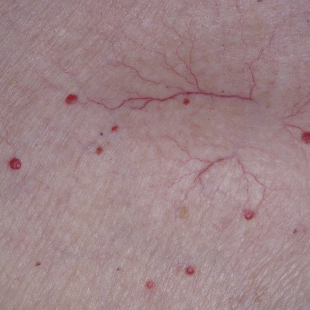 Lésions vasculaires — Dr Eloïse Moreau - Médecine esthétique Tassin