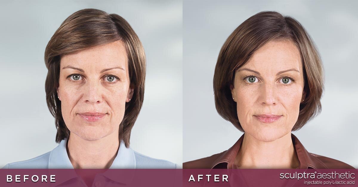 Sculptra — Uplift Skin and Body MedSpa