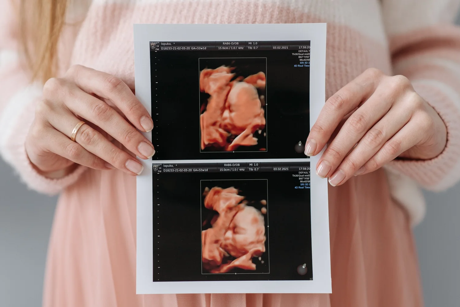 Elective 3D/4D Ultrasounds | Capture Life's Moments — Elite Ultrasound ...