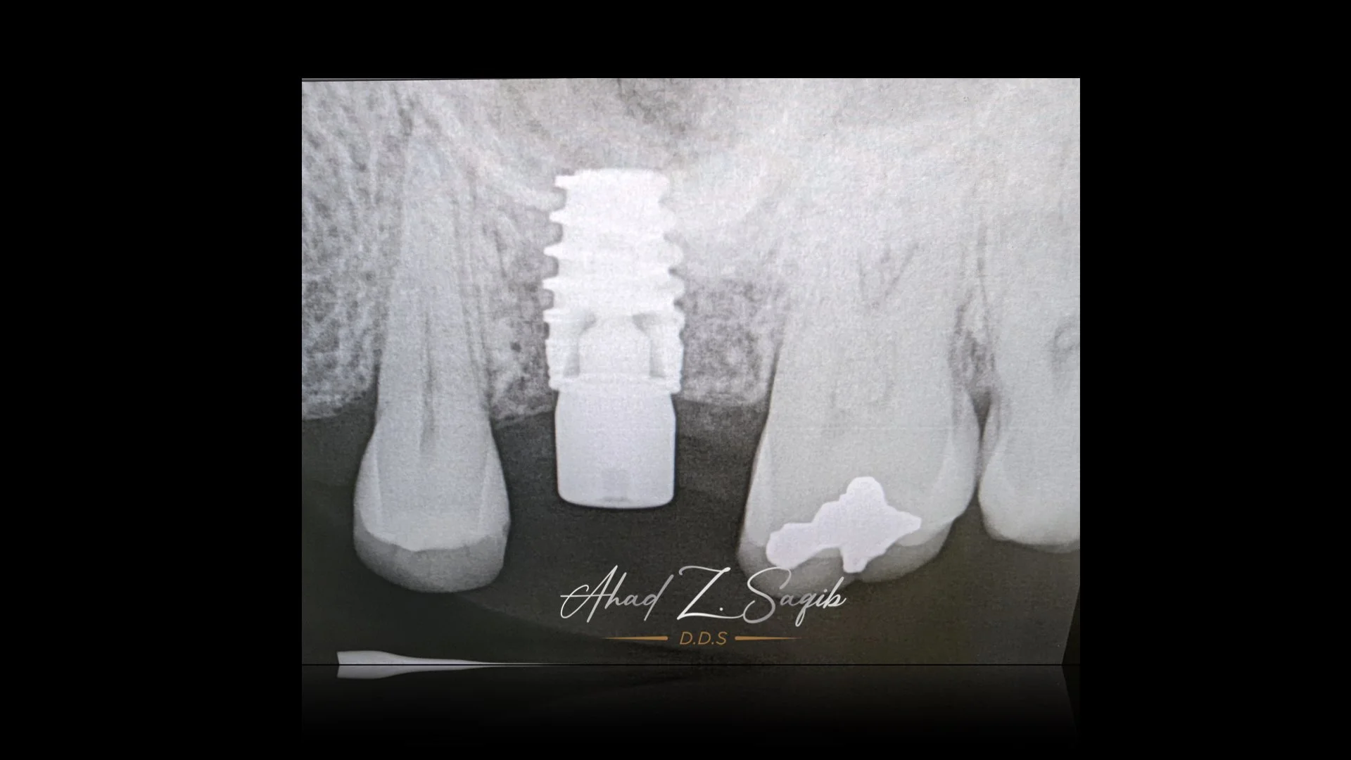 Implant Placement — Ahad Z. Saqib, DDS