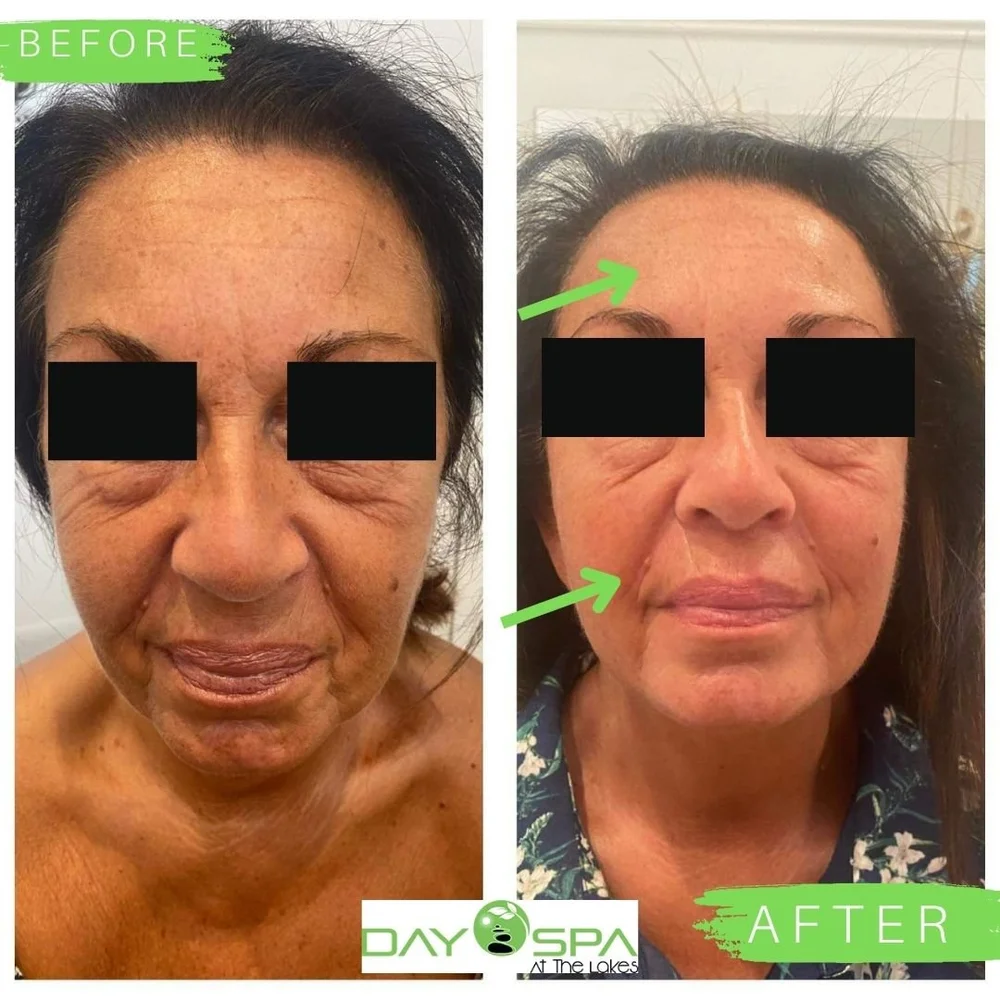 HIFU Treatment — Day Spa at The Lakes