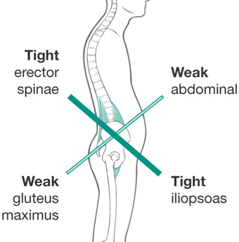 What Does A Misaligned Pelvis Feel Like?