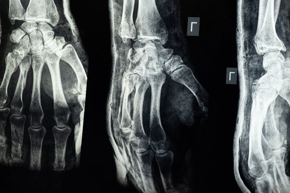Acute Fractures Explained – When Bones Take a Sudden Break