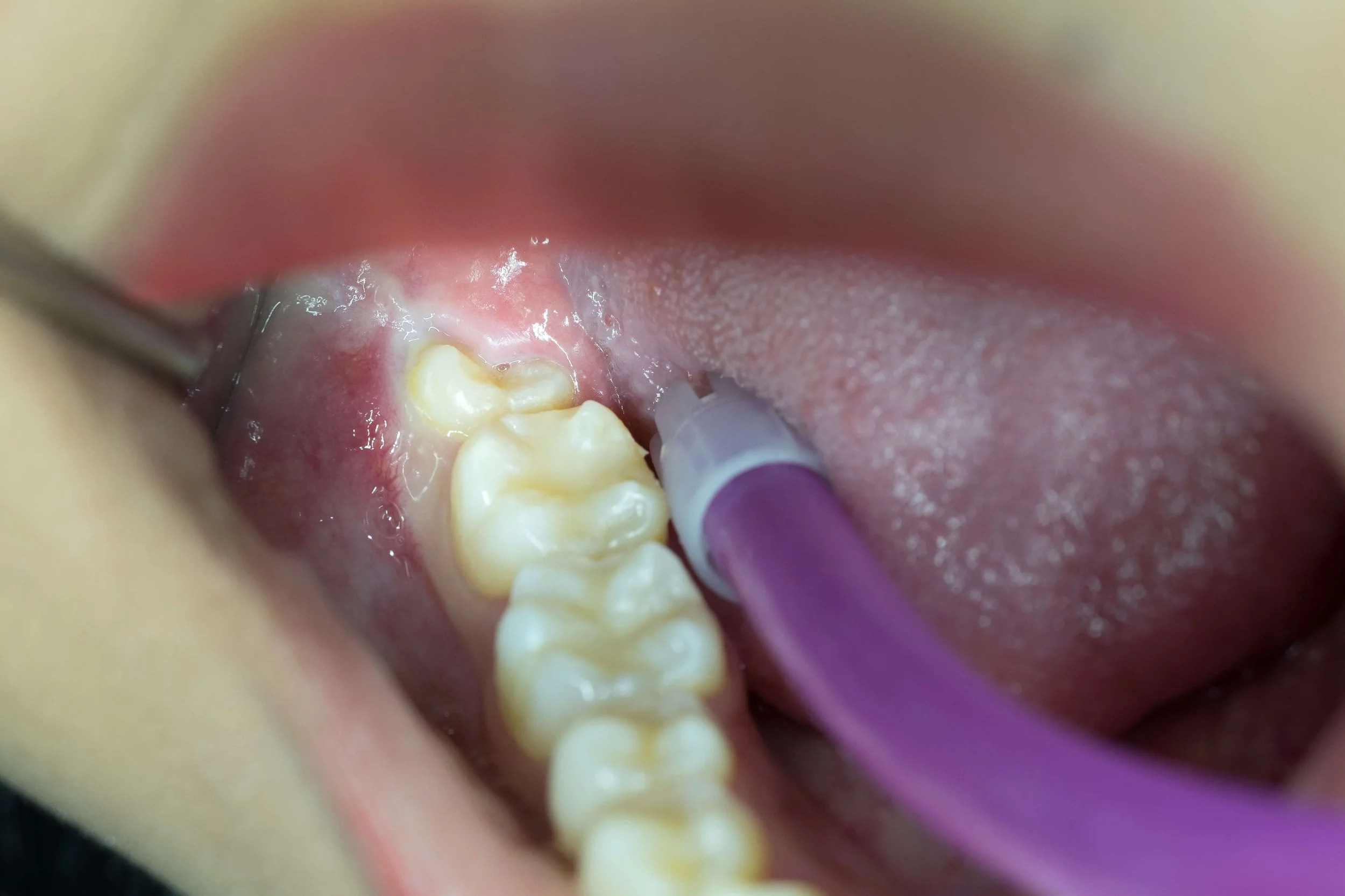 Wisdom Teeth — Bexley Dentists - Family and Kids Dentist - Serene Dental