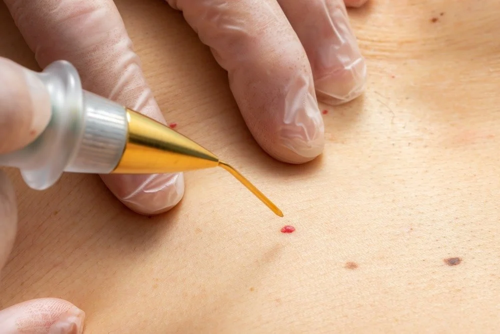 Understanding Cherry Angiomas: Causes and Symptoms