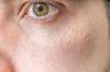 What is causing the bumpy skin under your eyes and how to treat it ...