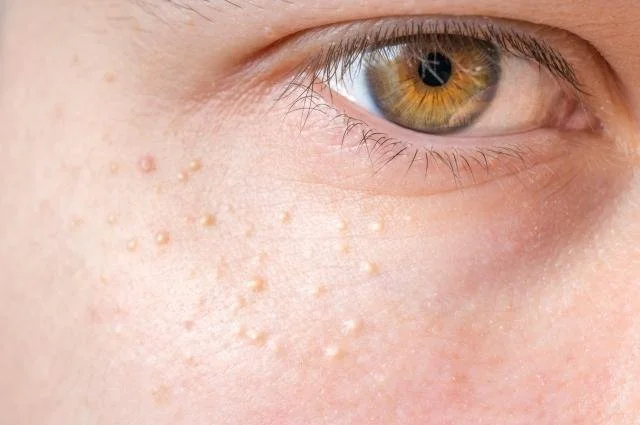 What is causing the bumpy skin under your eyes and how to treat it ...