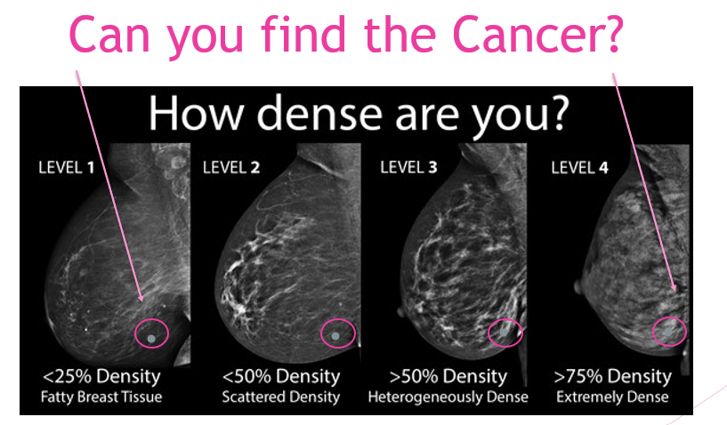 Operation Breast Density