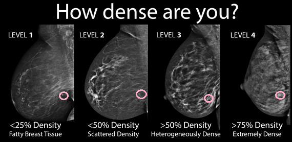 Breast Cancer Screening Patient Resources — Operation Breast Density