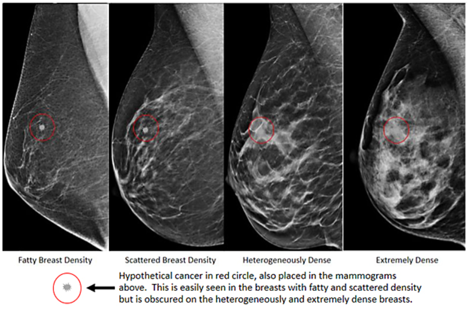 Operation Breast Density