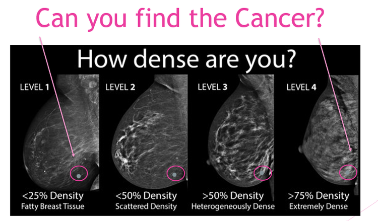 What is Breast Density? — Operation Breast Density
