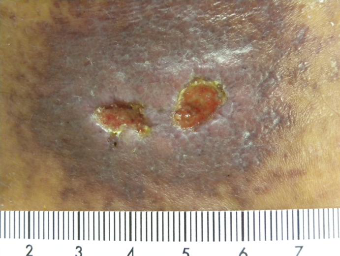 New Template: Chronic Wounds – Left Leg — HyOx - Hyperbaric Oxygen ...