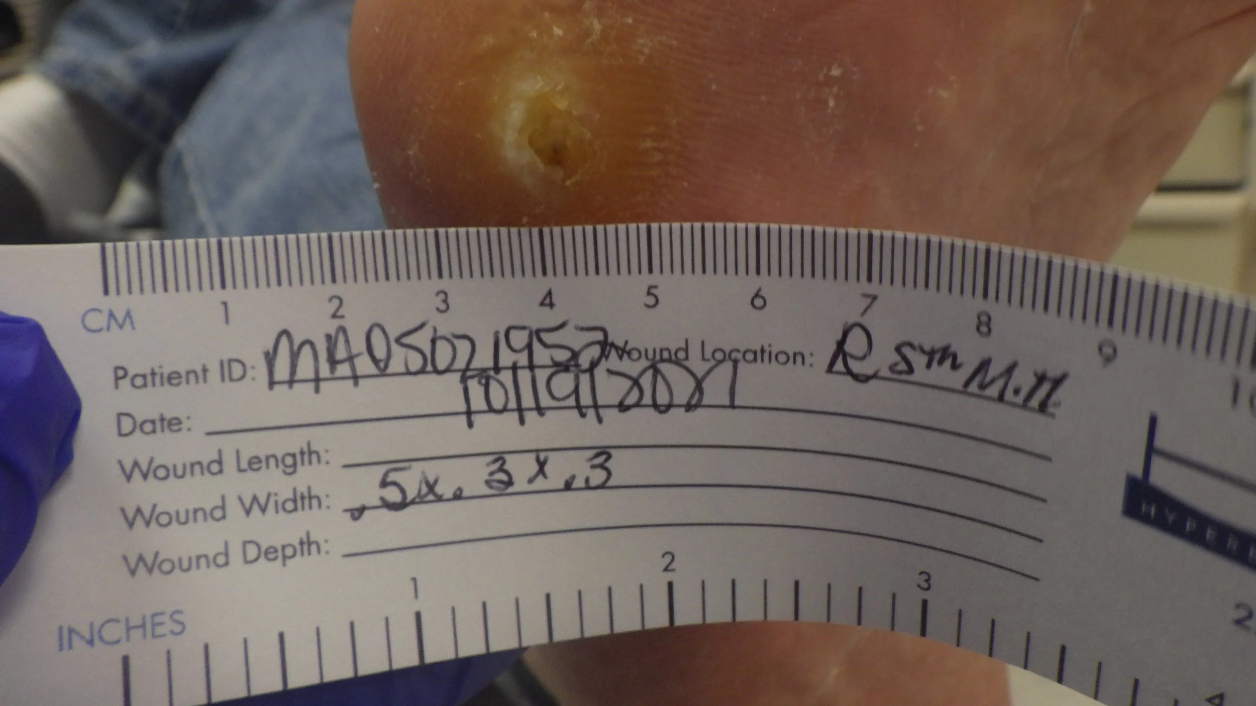 Chronic, Refractory Osteomeylitis of the Right Foot — HyOx - Hyperbaric ...