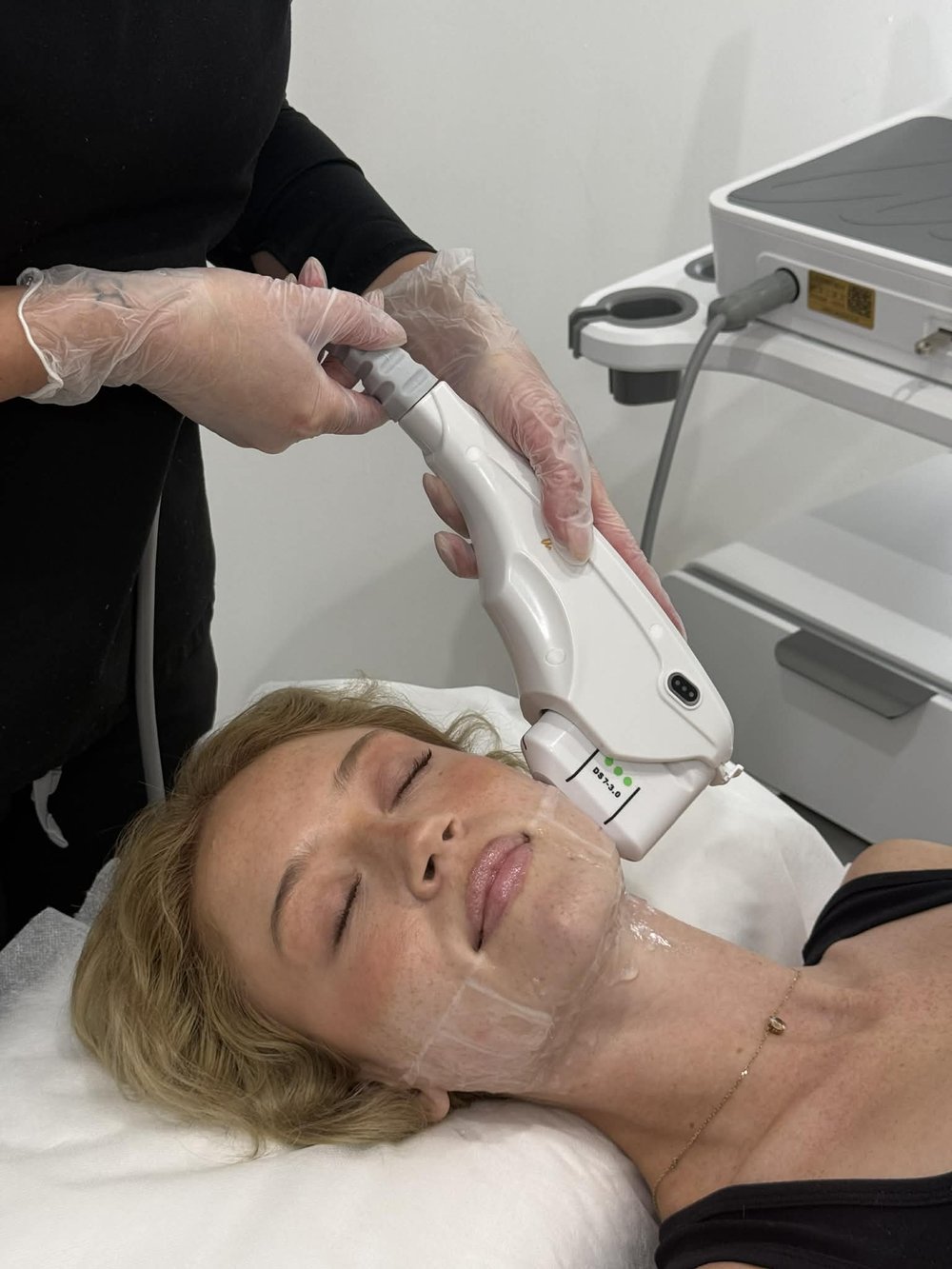 HIFU Perth | Ultherapy Prime Skin Tightening – Shape of You