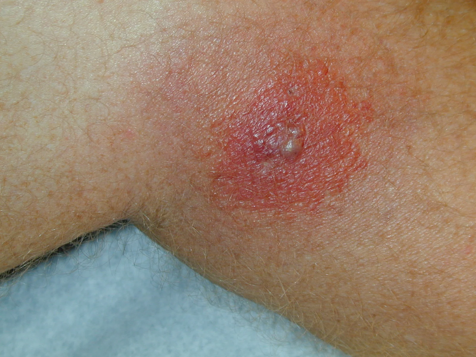 Normal Tick Bite Reaction