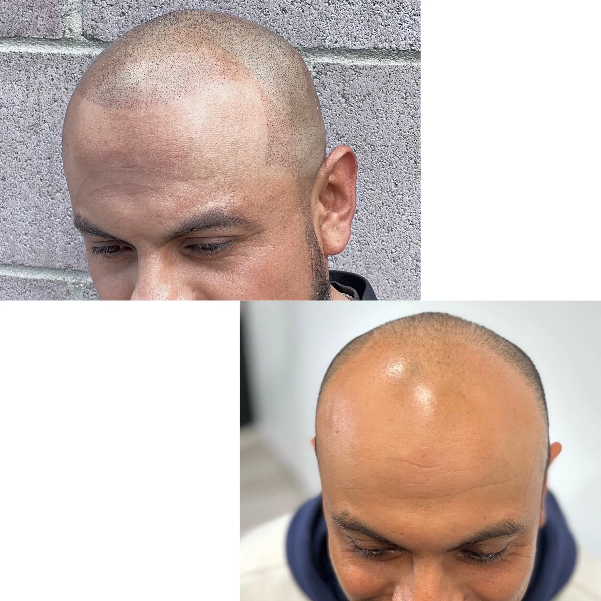 Scalp Micropigmentation by OlmecSMP in Los Angeles
