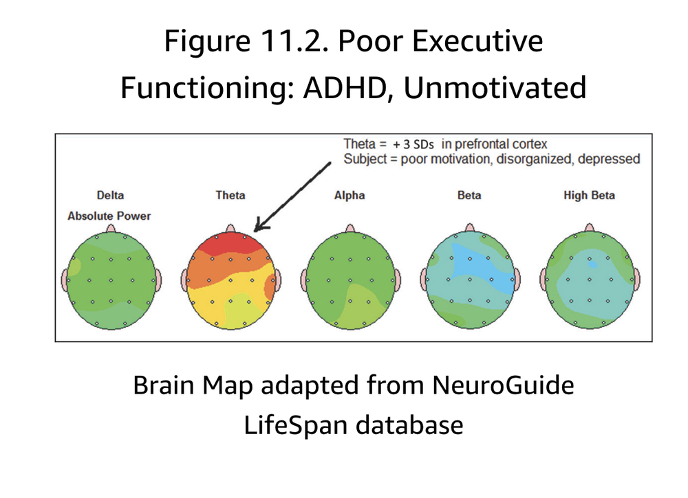 ADHD Houston Brain Mapping Therapy 77565 — ADHD & Neurofeedback Clinic