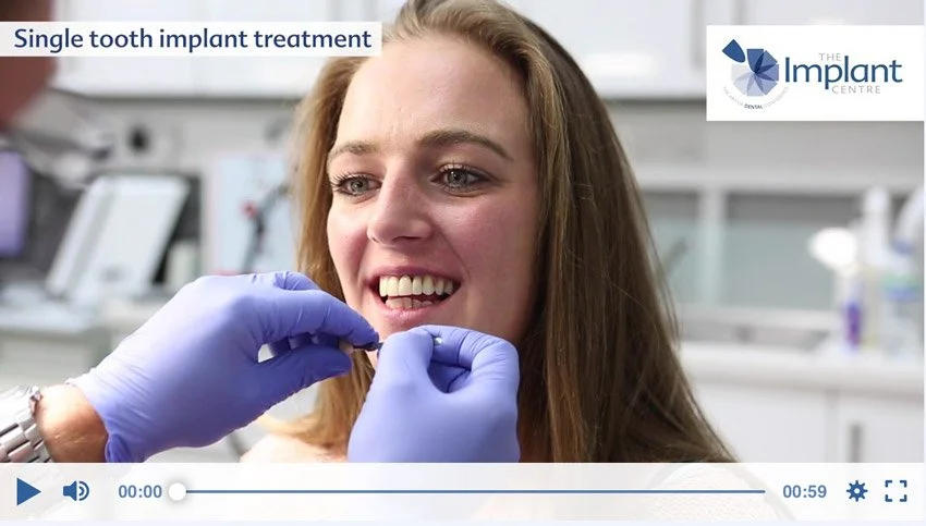 Implant Treatments: Single-Tooth Overview