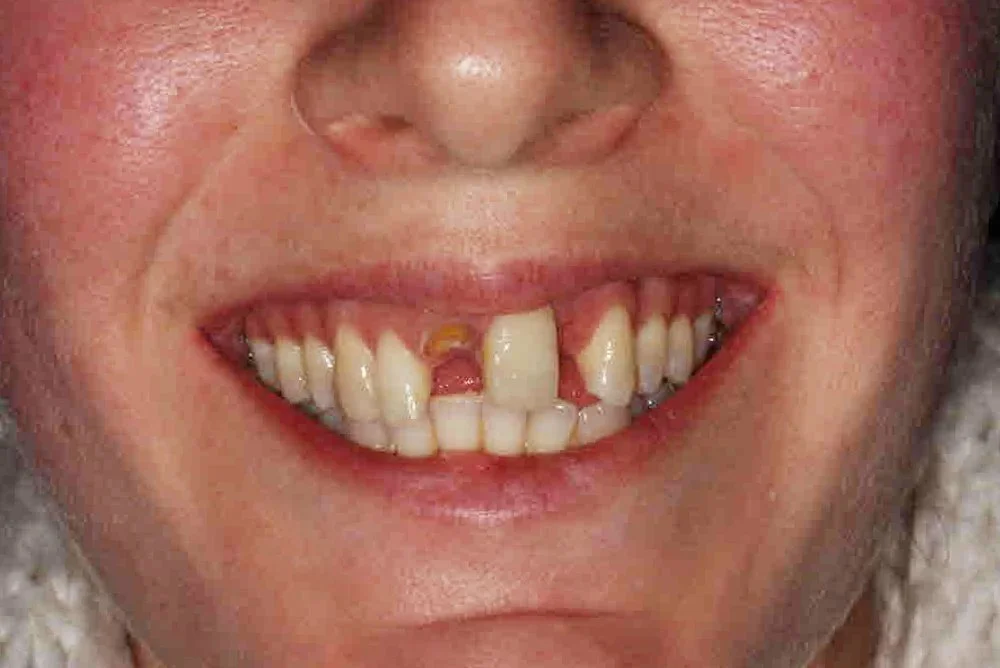 Implant Treatments — The Implant Centre | Dental Implants