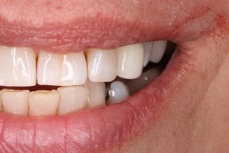 Instant Dental Implants & Teeth in Brighton & Hove