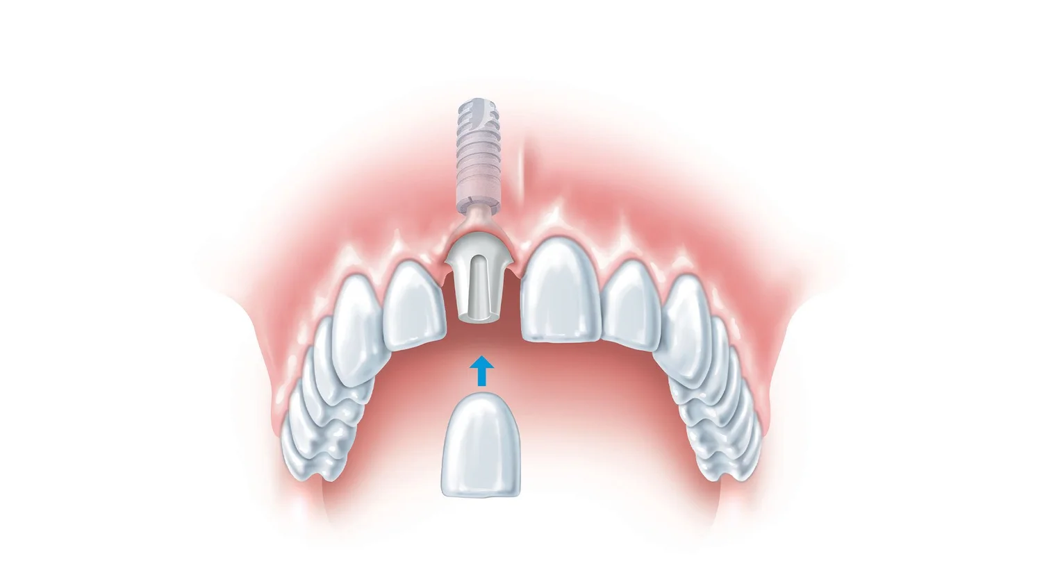 Single Tooth Implants in Brighton & Hove