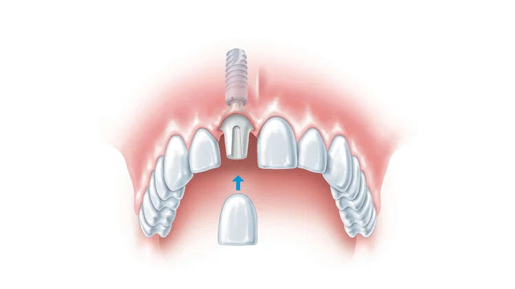 Single Tooth Implants in Brighton & Hove