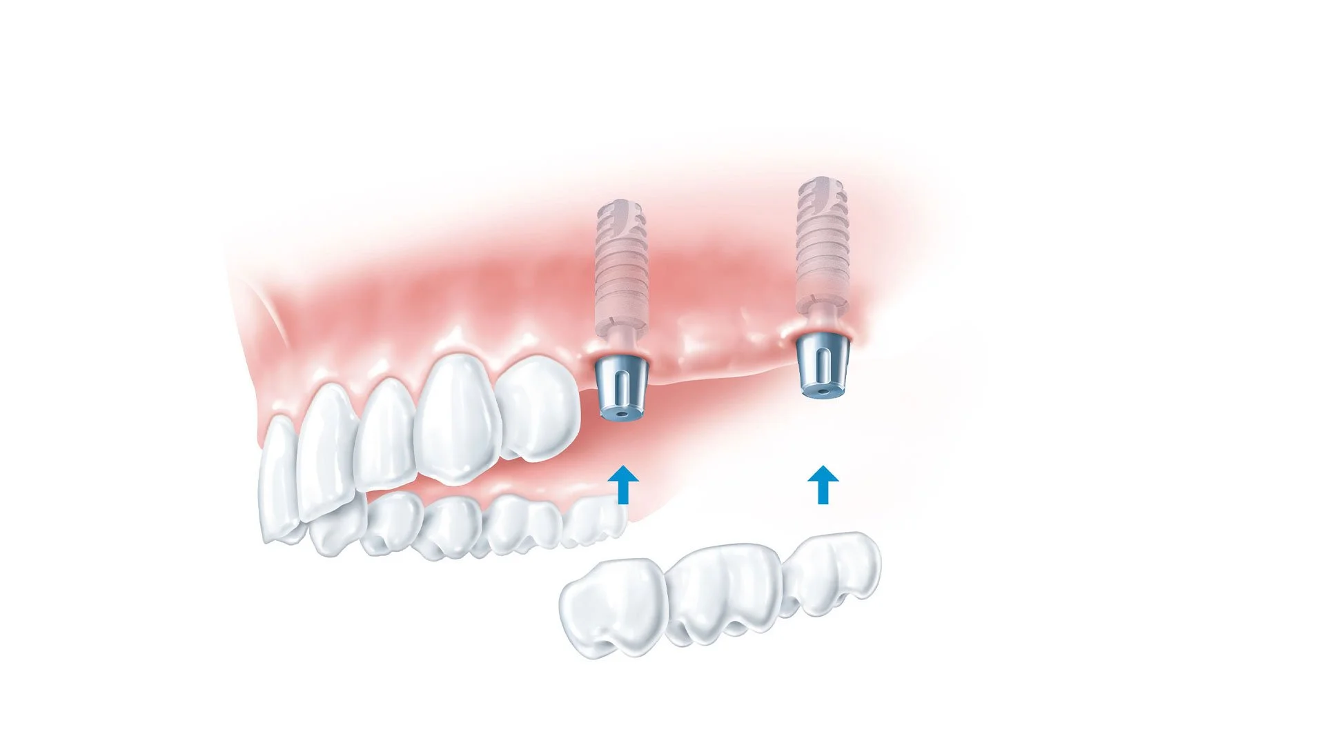 Multiple Teeth Implants in Brighton & Hove