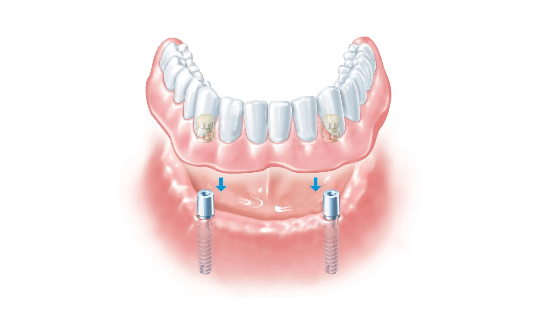 Implant Overdentures in Brighton & Hove