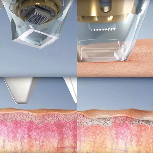 SENTIENT TIXEL® — you+ Medical Aesthetics: Med Spa Treatments and Services