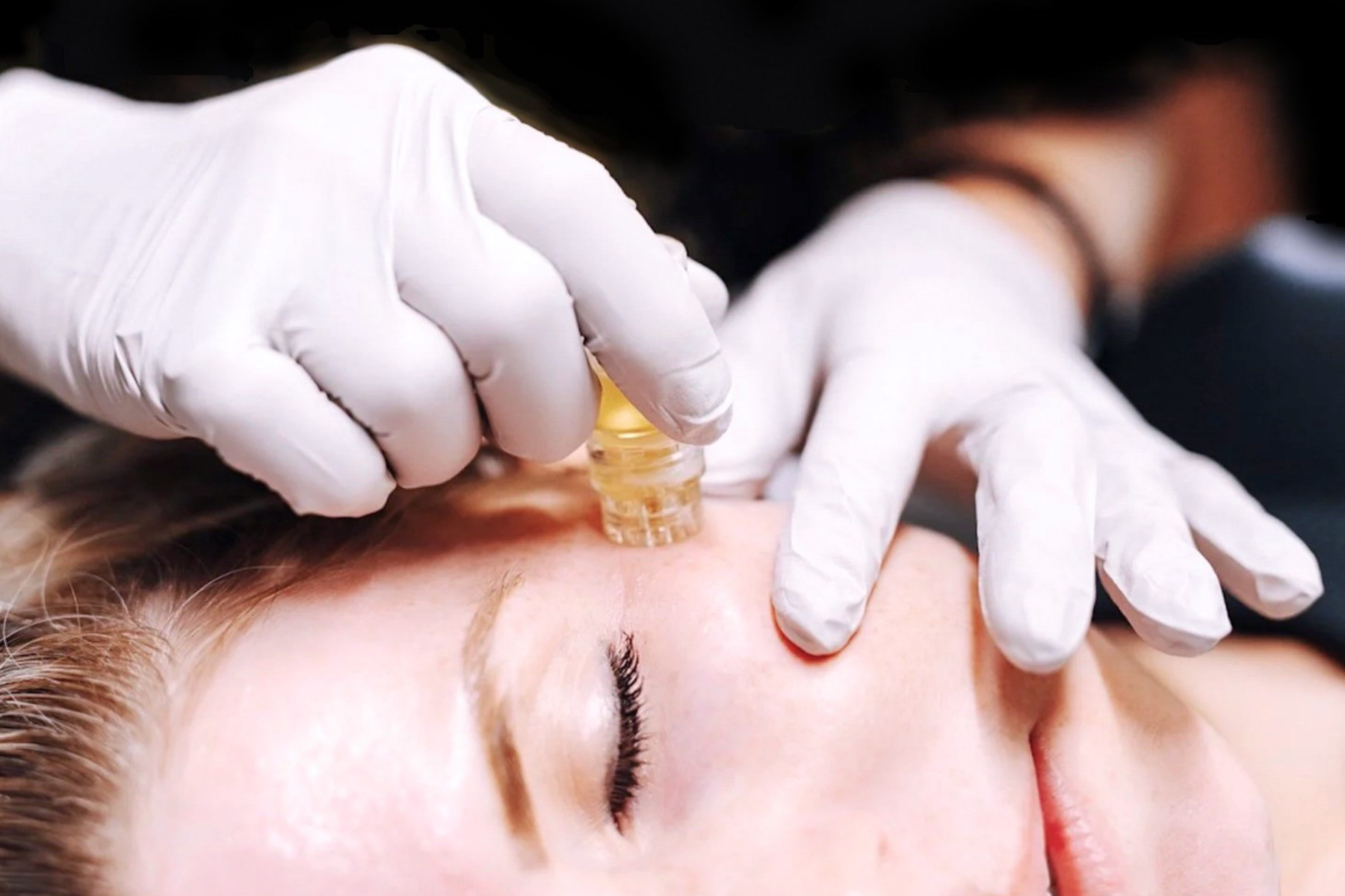 MICRO-TOX INSTANT FACIAL — you+ Medical Aesthetics: Med Spa Treatments ...