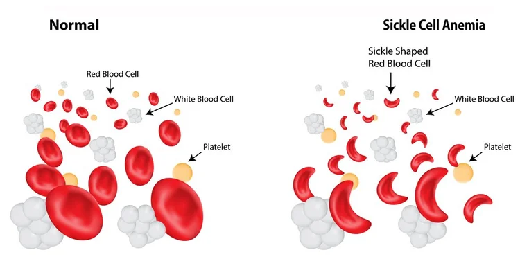 What is sickle cell disease? — Massachusetts Sickle Cell Association