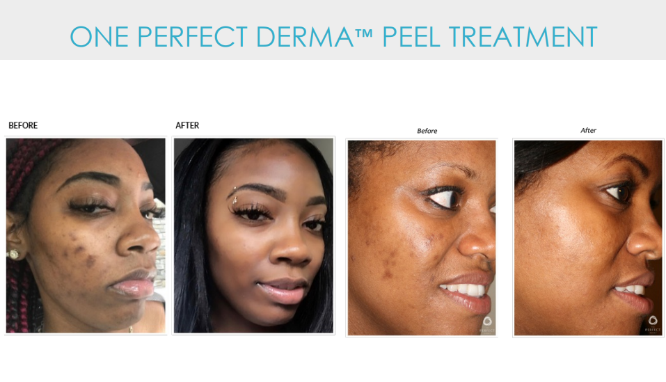 Chemical Peel — Luxe` Esthetics Studio