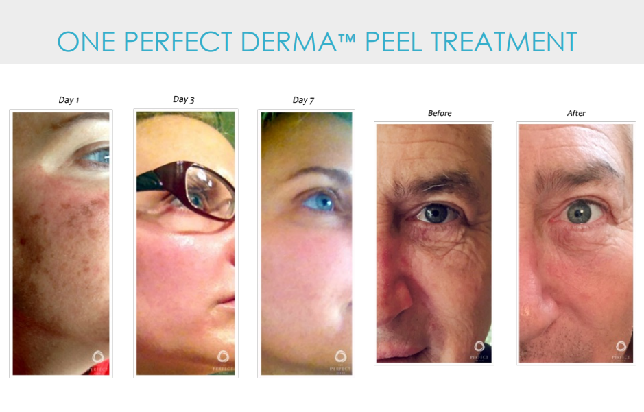 Chemical Peel — Luxe` Esthetics Studio