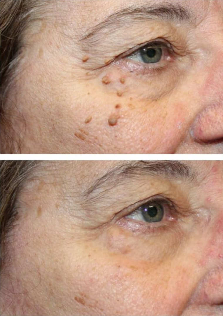 Skin Tags Removal | Book Your Skin Tag Removal Today — Silk Aesthetic ...