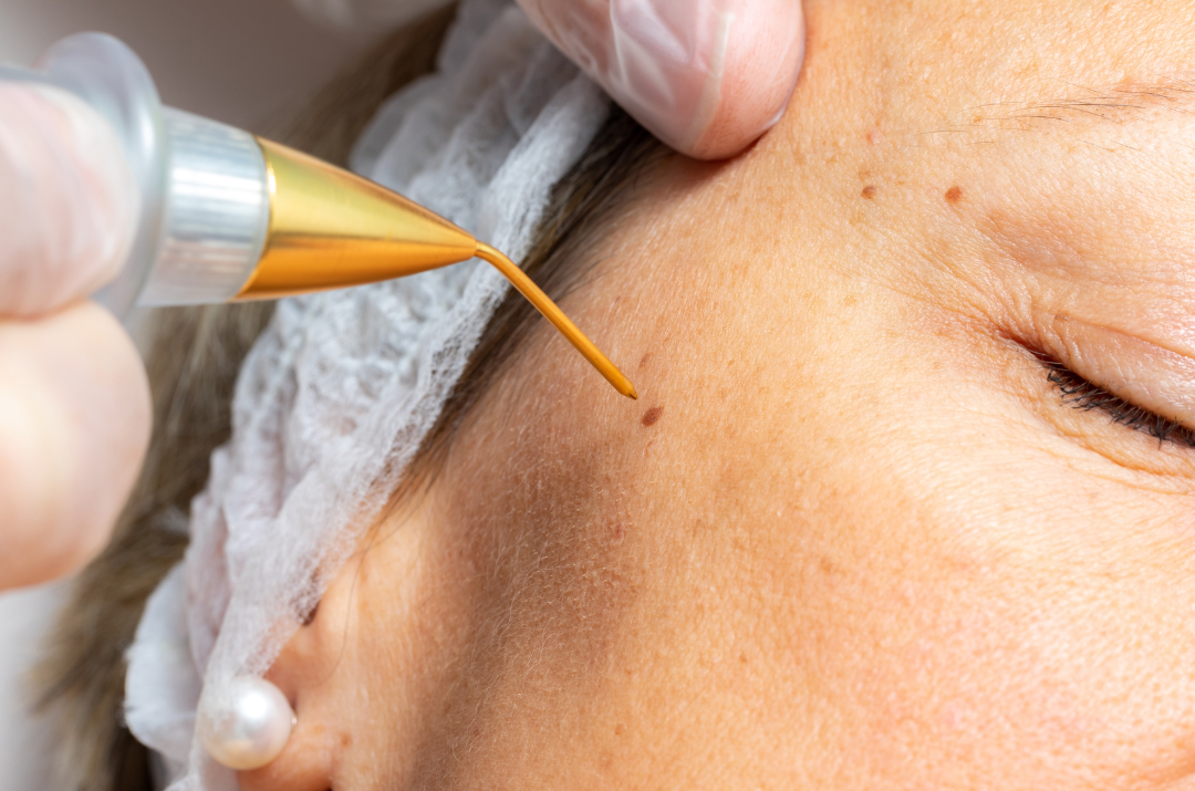 SKIN TAG REMOVAL: WHAT YOU NEED TO KNOW — Silk Aesthetic Clinic