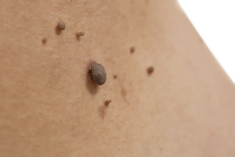 MOLES CAUSES AND PREVENTION: WHAT YOU NEED TO KNOW — Silk Aesthetic Clinic