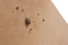 MOLES CAUSES AND PREVENTION: WHAT YOU NEED TO KNOW — Silk Aesthetic Clinic