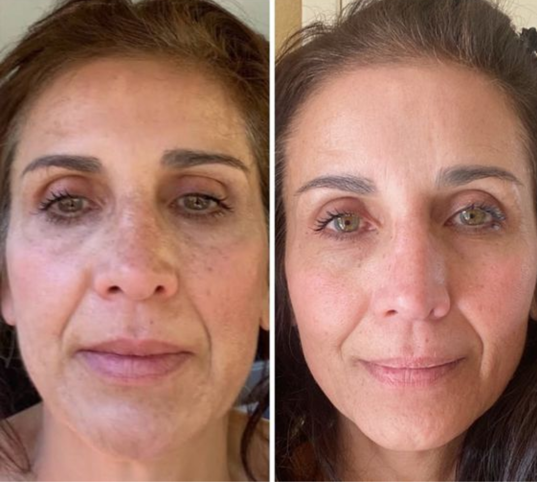 Platelet-rich plasma (PRP) | Enhance Natural Beauty Today — Silk ...