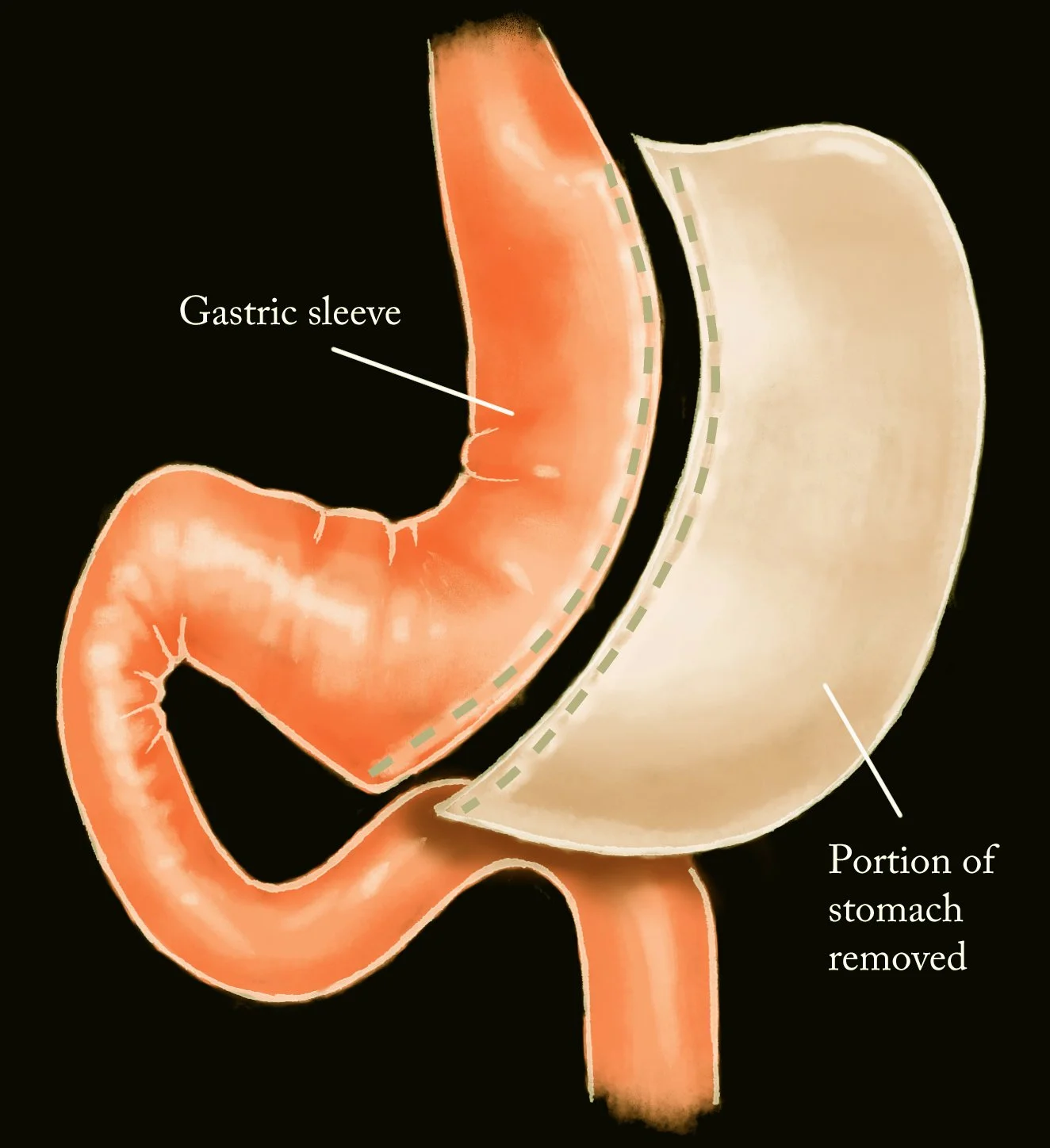 Brisbane Bariatric Centre — Weight Loss Surgery