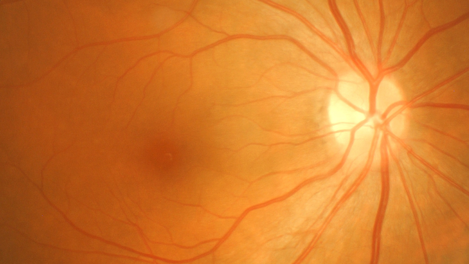 Retinal Imaging — Blink Opticians, Bridge of Allan
