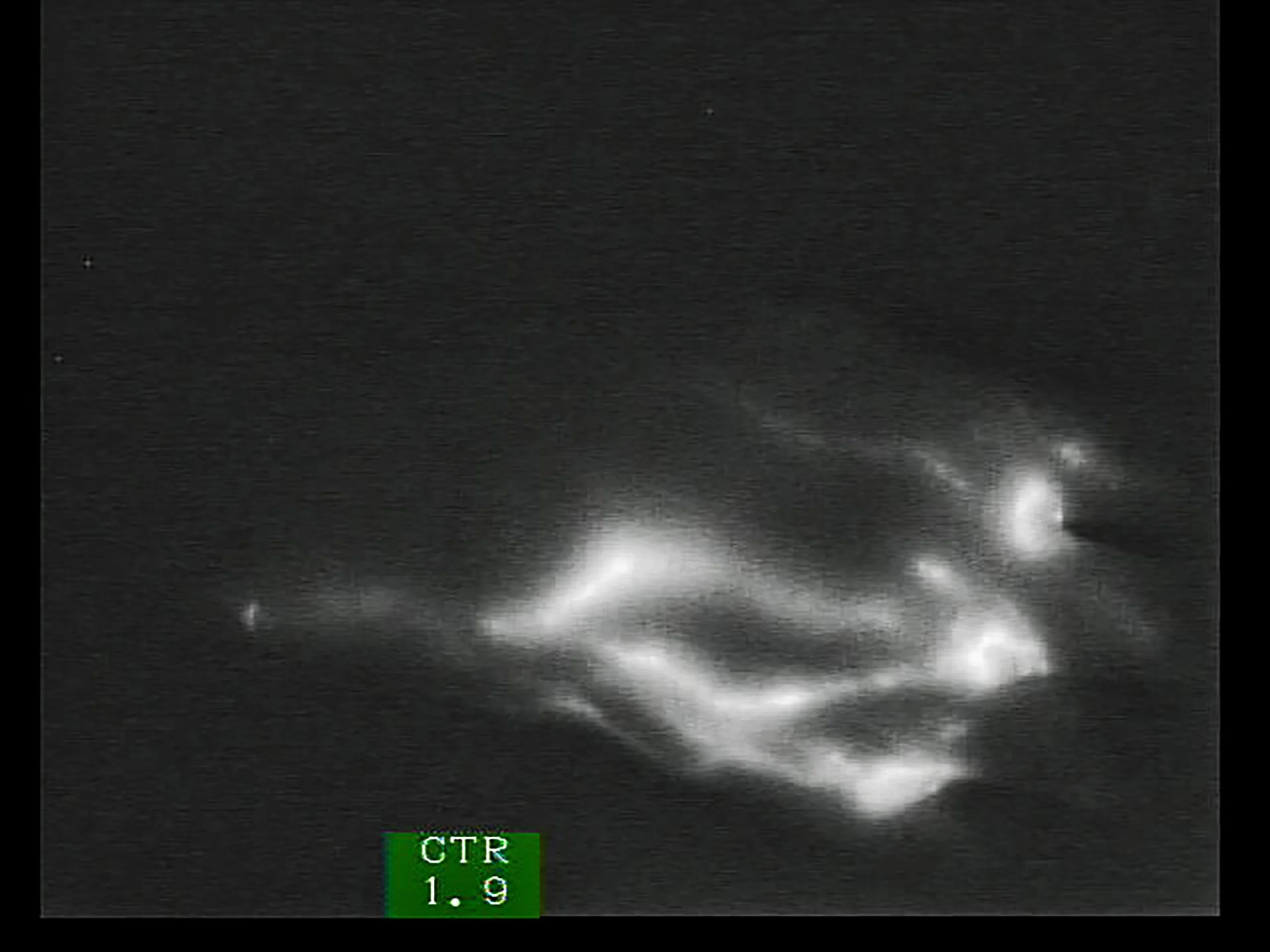 Lymphedema ICG Mapping | San Francisco — The Buncke Clinic